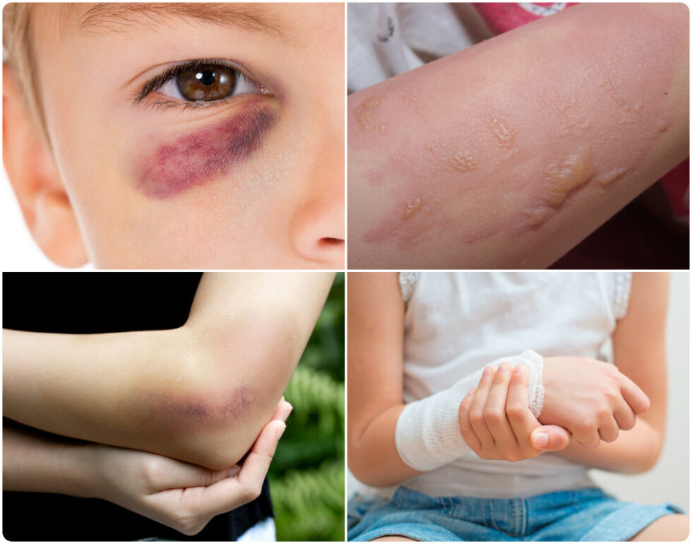 Types & Signs - Non-Accidental Injury